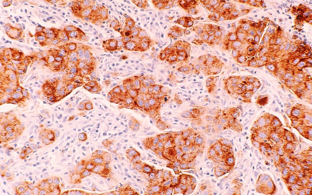 Células madre de cordón umbilical en cáncer de próstata